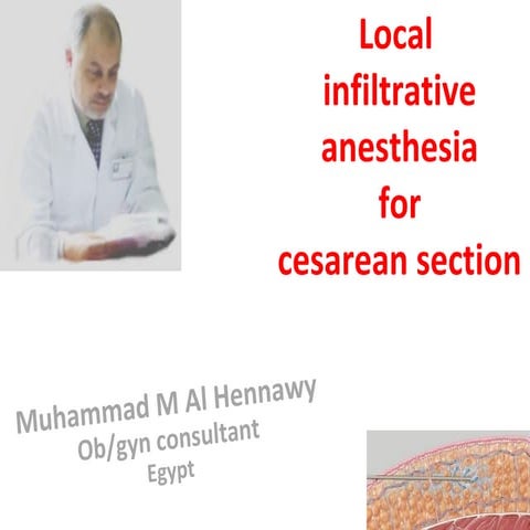 Local infiltrative anesthesia for cesarean section | PPT