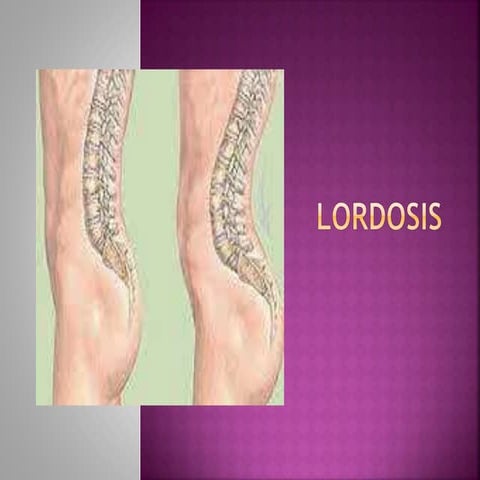 Lordosis shb | PPTX