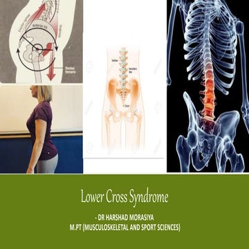 Lower cross syndrome | PPTX