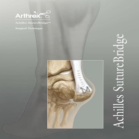 Lt0460 b achilles suturebridge | PDF