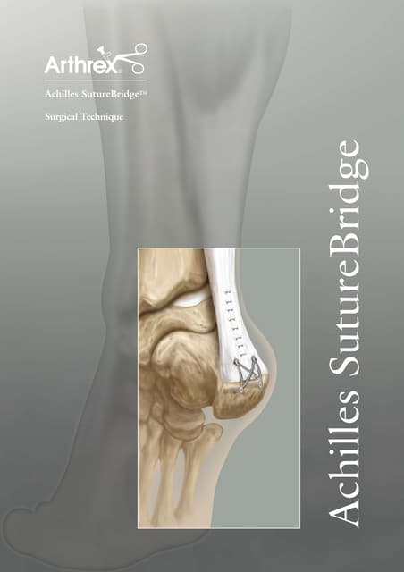 Lt0515 d suturebridge | PDF