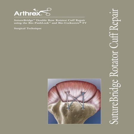 Lt0515 d suturebridge | PDF