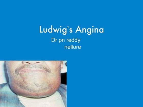 Ludwig's angina | PPTX | Ear, Nose and Throat Conditions | Diseases and ...