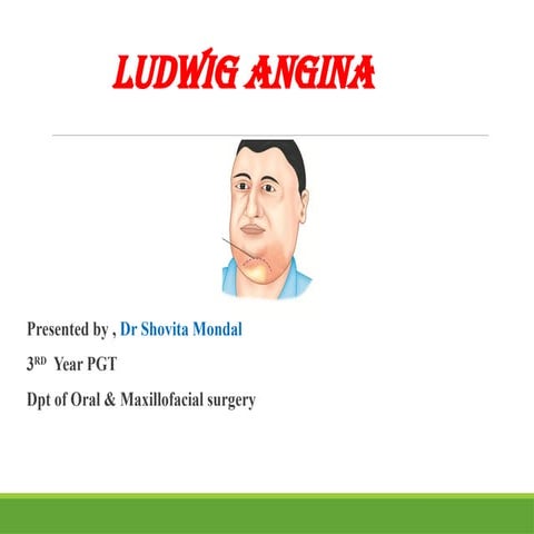 ludwigs angina - a life threatening condition | PPTX