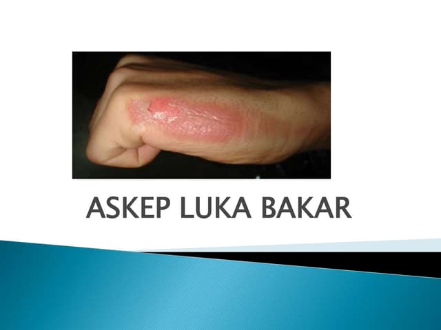 Askep Luka Bakar | DOCX