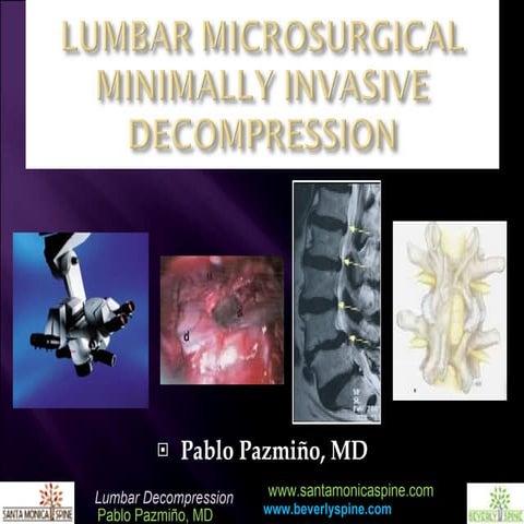 Lumbar Decompression | PPT