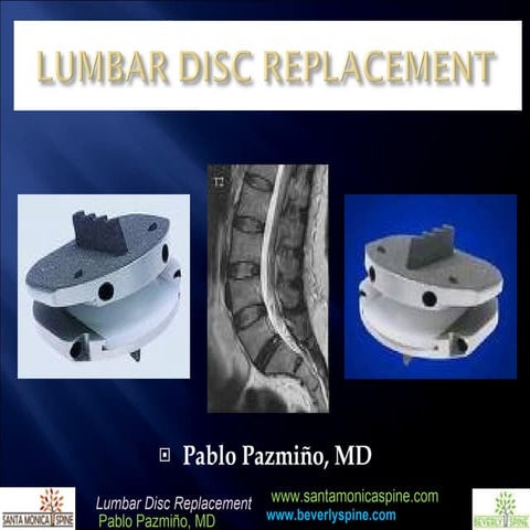 Lumbar Disc Replacement | PPT