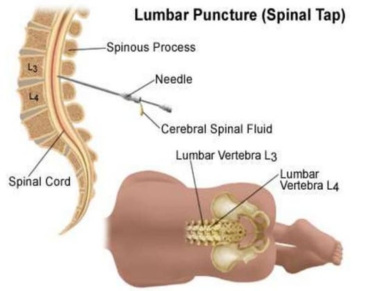 Cerebrospinal fluid (CSF) and interpreting lumbar puncture | PPT