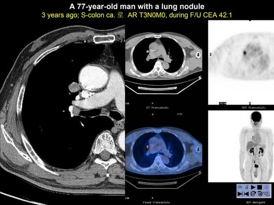 Pulmonary chondroid hamartoma | PPS