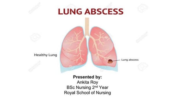 Lung abscess_102210.pptx | Lung and Respiratory Health | Diseases and ...