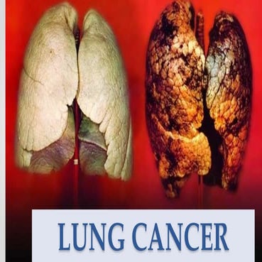 LUNG CANCER | PPTX