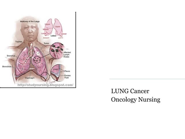 Lung Cancer Ppt