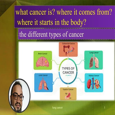 lung cancer | PPT