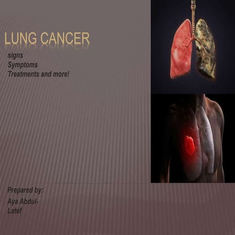 Lung cancer | PPTX