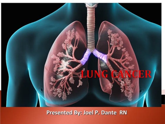 Lung Cancer 101 | PPT