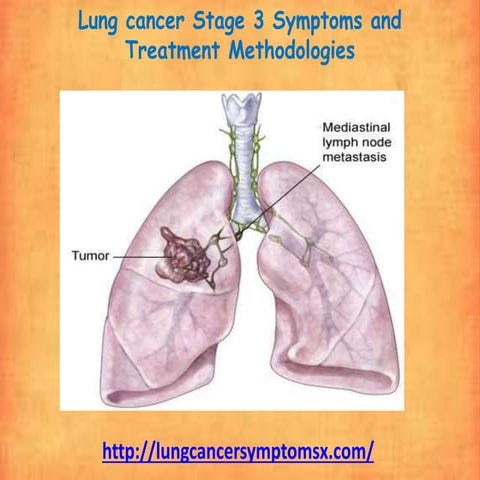 Lung cancer stage 3 symptoms and treatment methodologies | PPTX