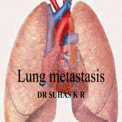management of lung mets | PPTX