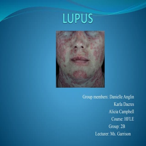Lupus | PPTX