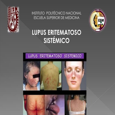 lupus eritematoso sistemico exposicion medicina interna | PPTX