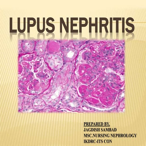 Lupus nephritis | PPTX
