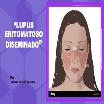 Lupus presentación..pptx