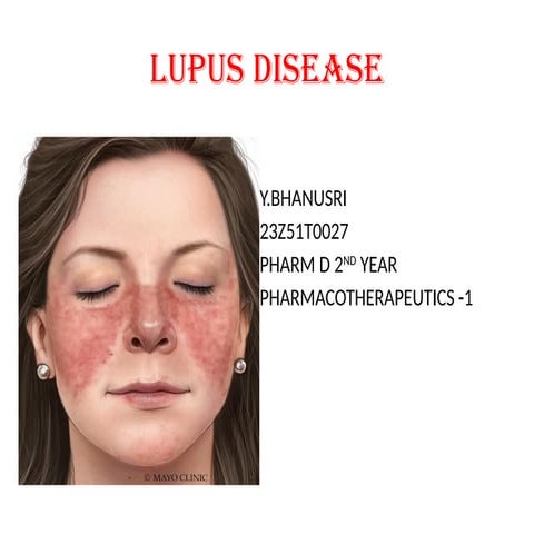 lupus disease _ pptx presentationon | PPTX