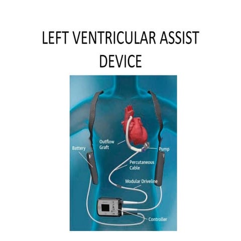 LVAD.pptx