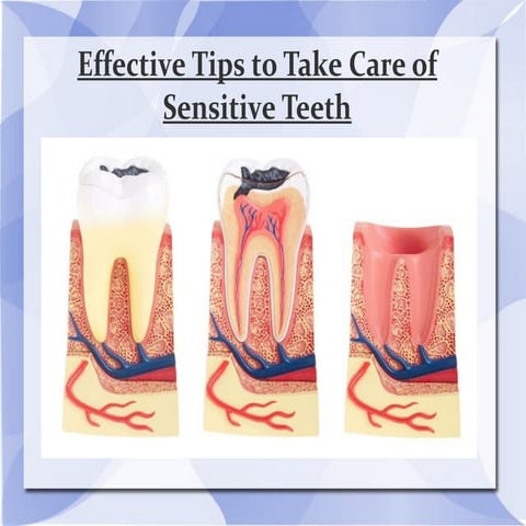 Effective Tips to Take Care of Sensitive Teeth | PPT