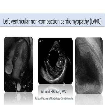 LV non-compaction cardiomyopathy | PDF | Heart and Cardiovascular ...