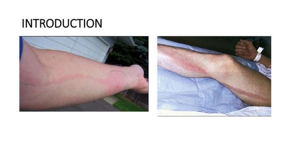 NECROTISING FASCITIS AND MANAGEMENT.pptx