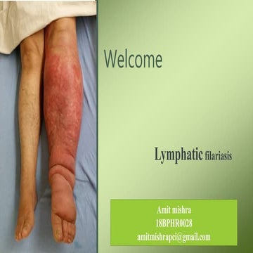 Lymphatic filariasis.pptx