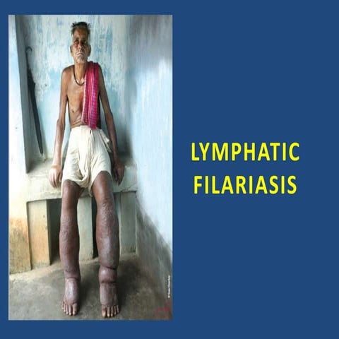 LYMPHATIC FILARIASIS Community medicine.pptx | Infectious Diseases ...