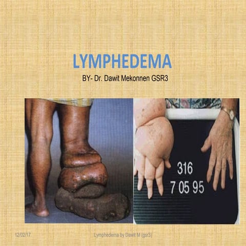 Lymphedema by Dr.dawit surgical resident@ Jimma university | PPT