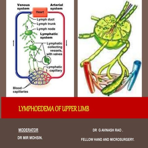 Lymphoedema of upper limb | PPTX
