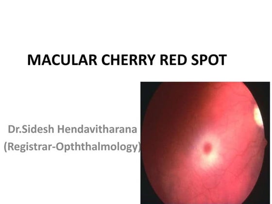 Age related macular degeneration | PPTX