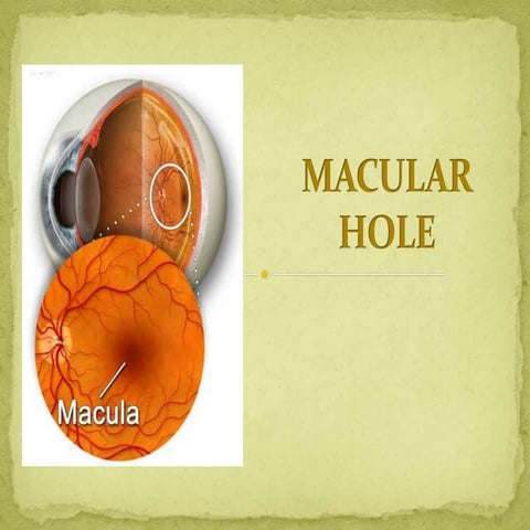 Macular hole | PPTX