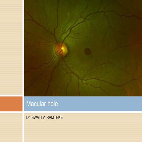 MACULAR HOLE.pptx