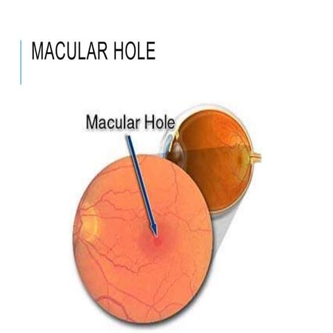 macular hole.pptx
