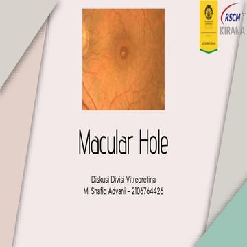 power point presentation of Macular Hole.pptx