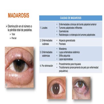 madarosis.pptx