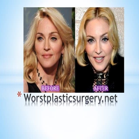 Madonna Plastic Surgery Gallery | PPTX