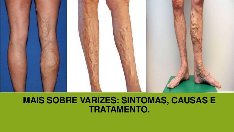 Mais sobre varizes: sintomas, causas e tratamento.
