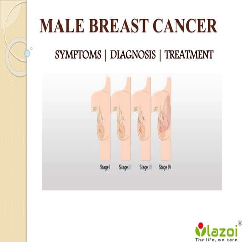 Male Breast Cancer : Symptoms, diagnosis and treatment | PPTX