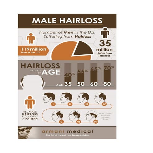 Male Pattern Baldness | PDF
