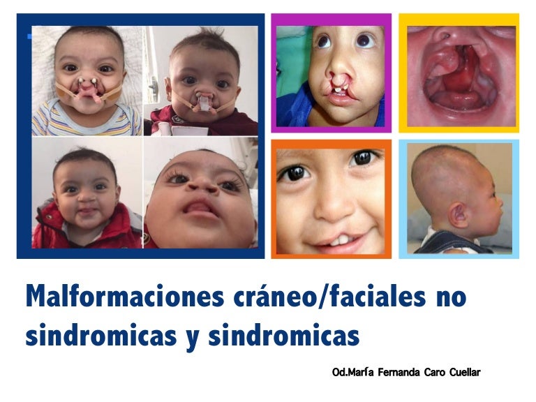 Malformaciones Craneofaciales No Sindromicas y Sindromicas.