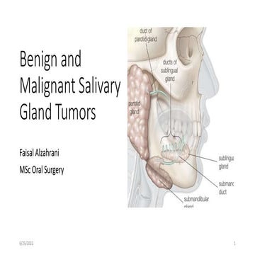 benign and Malignant Salivary Gland Tumors.pptx