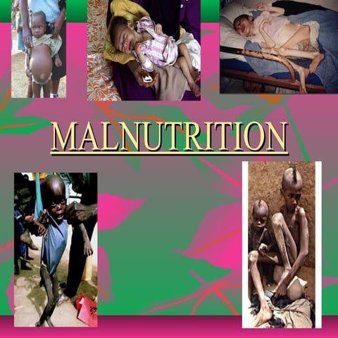 Malnutrition description | PPT
