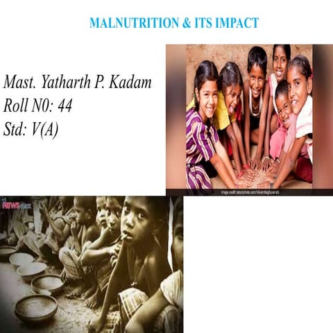 Malnutrition | PPTX