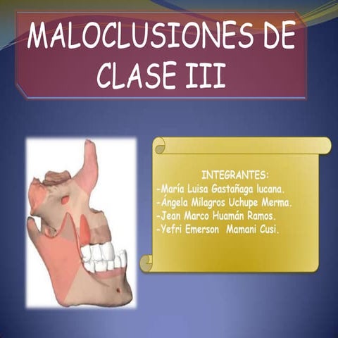 Maloclusiones de clase_iii | PPTX