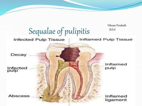 Periapical Abscess.pptx